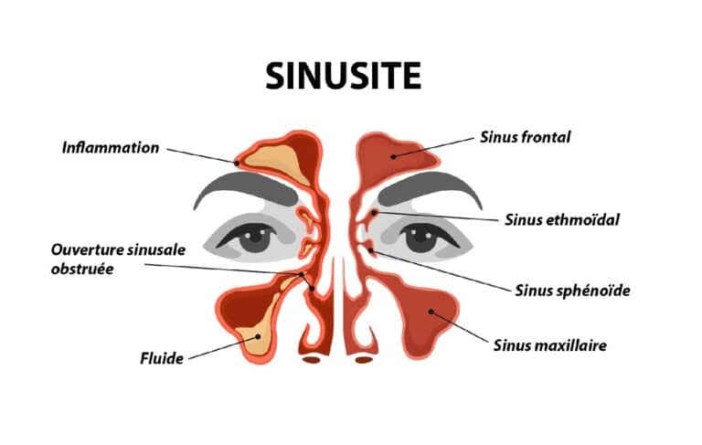 La sinusite: Causes et Symptômes de la pathologie - Information ...