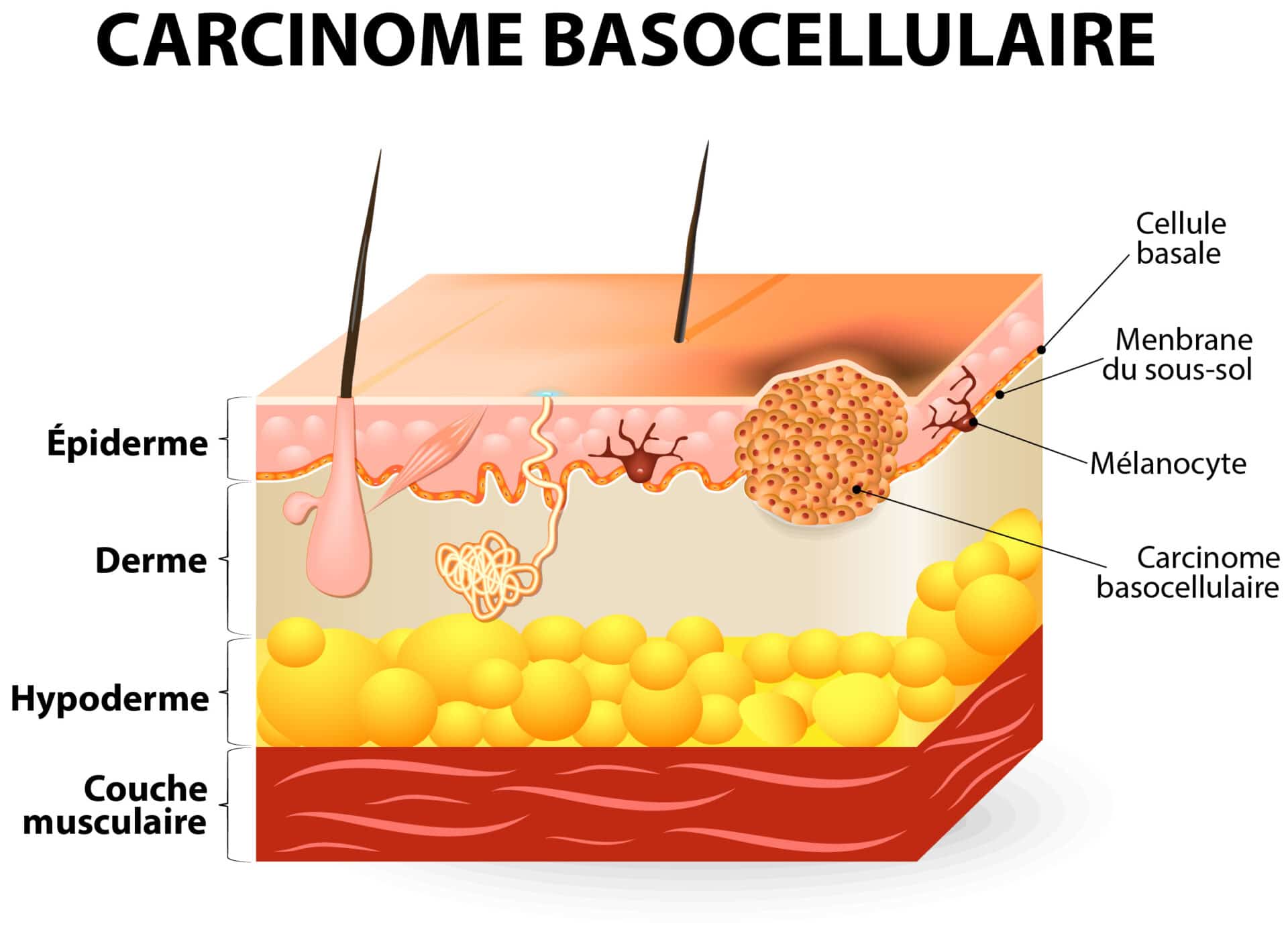 Cancer de la peau : Causes, Symptômes et Traitements - Information ...
