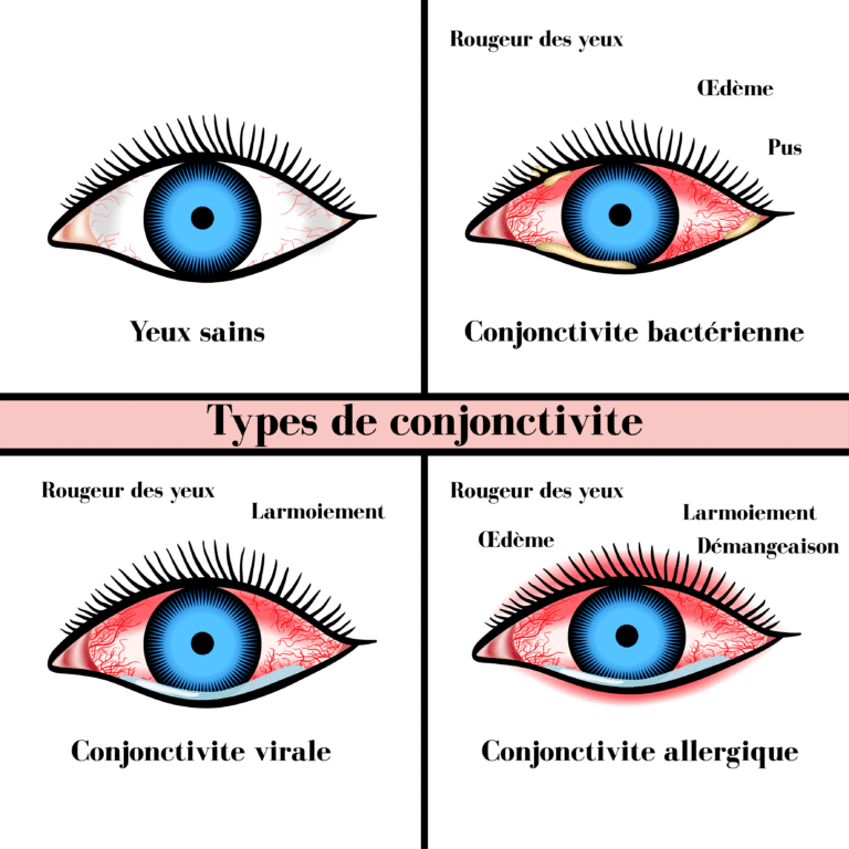 Conjonctivite : Causes, Symptômes et Traitements - Information ...