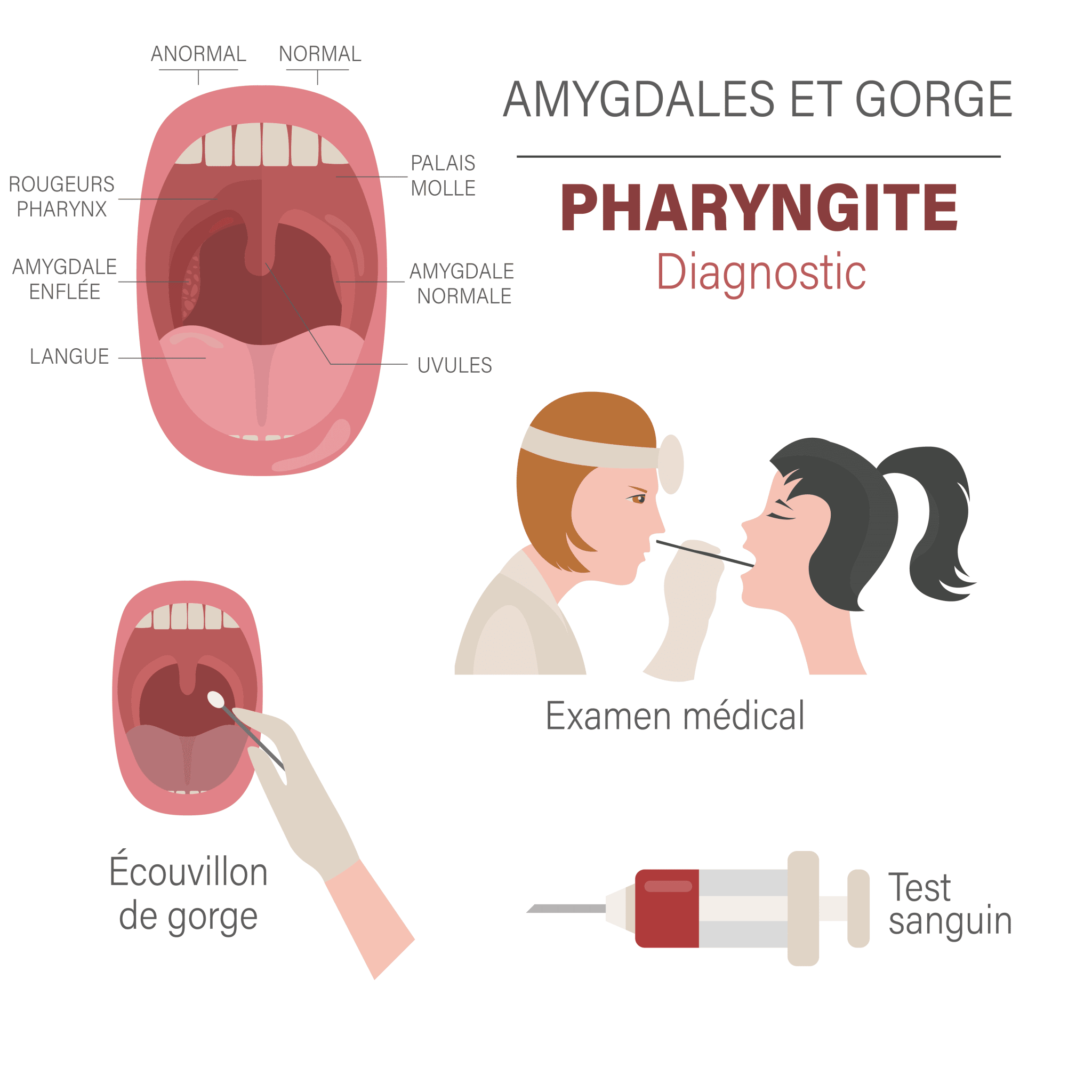 Pharyngite : symptômes, durée et traitements