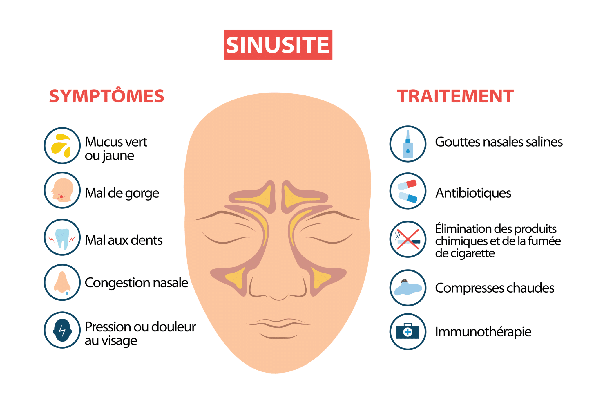 Sinusite chronique : causes, signes et traitements