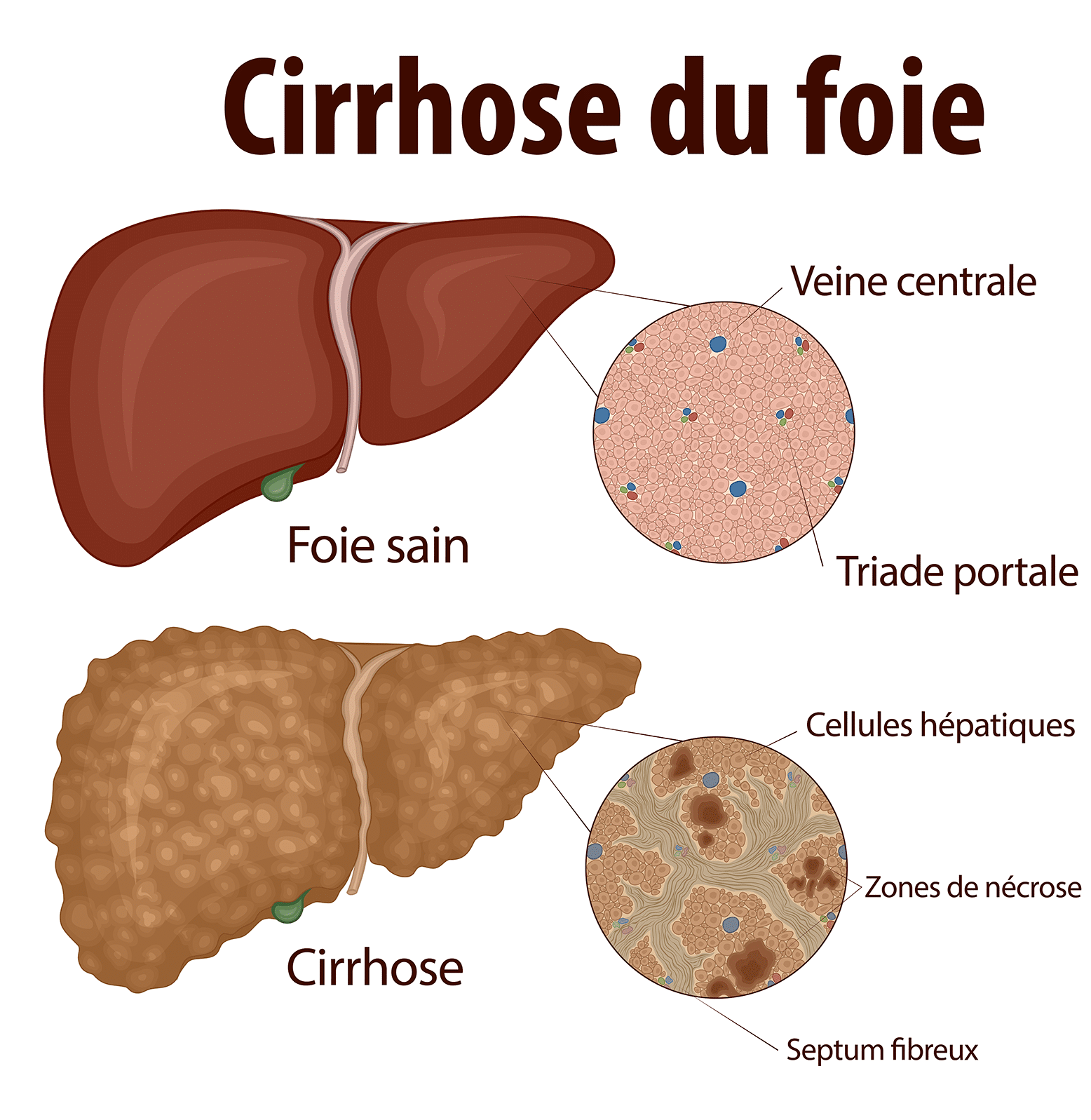 Ictère : causes, symptômes et traitements
