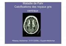 Les tumeurs au cerveau : causes, symptômes et traitements